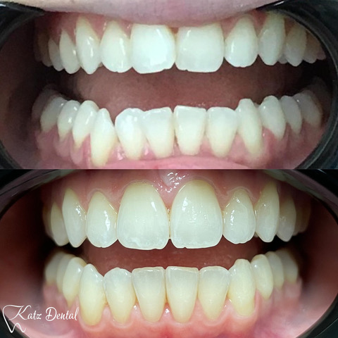 Smile Gallery | Katz Dental