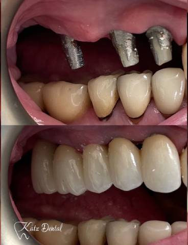 Smile Gallery | Katz Dental