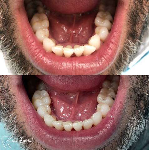 Smile Gallery | Katz Dental