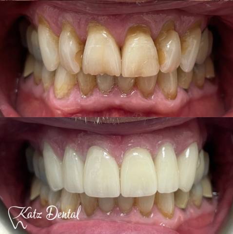 Smile Gallery | Katz Dental