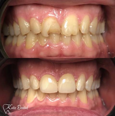 Smile Gallery | Katz Dental