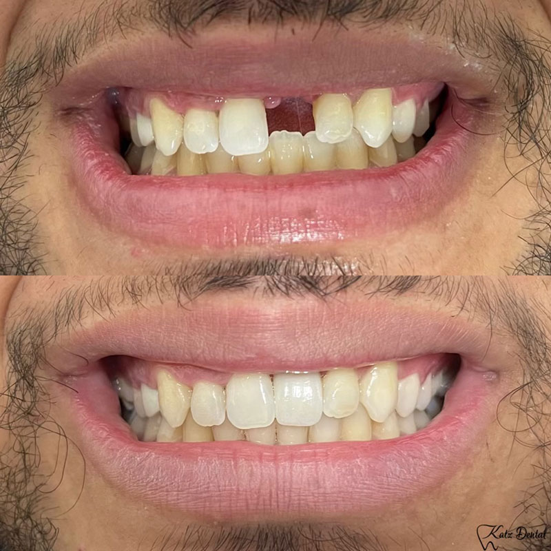 Smile Gallery | Katz Dental